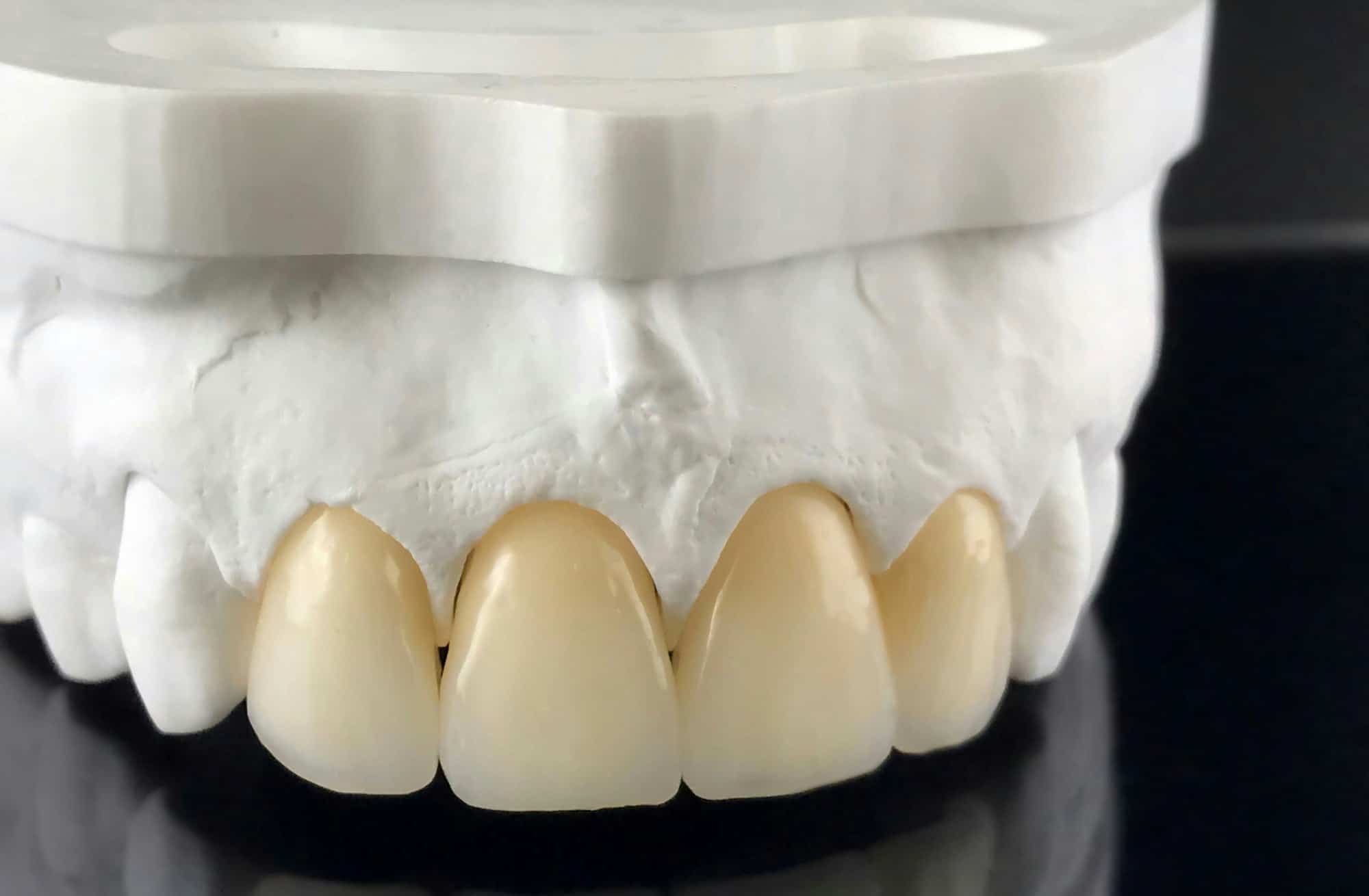 Zirconia Crowns | Techniques Dental Lab, Columbus Ohio